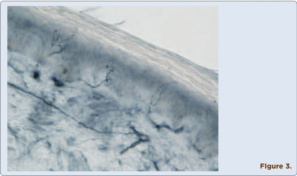 Diagnosis of Reflex Sympathetic Dystrophy / Complex Regional Pain ...